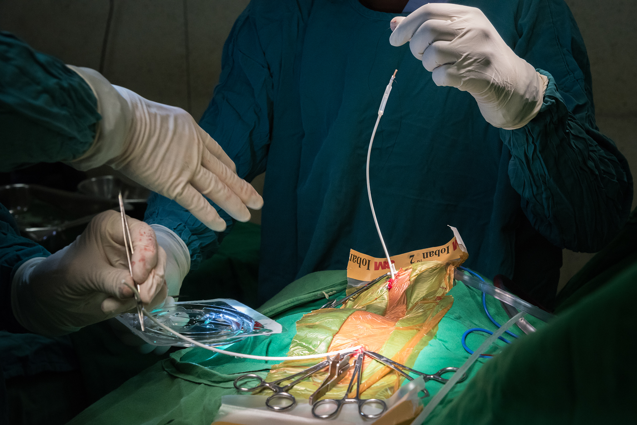 Shunt-Operationen - Child-Help Germany